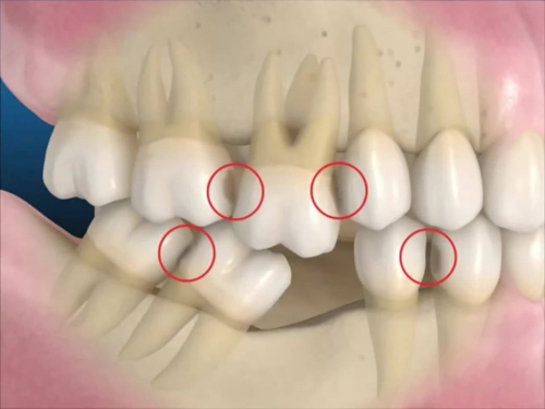 Dental Implants: Complete Guide, Types and Functions - IDW